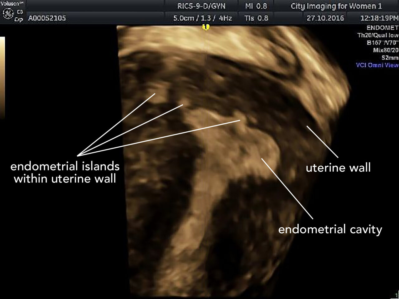 Adenomyosis – Sister to endometriosis or distant cousin ...